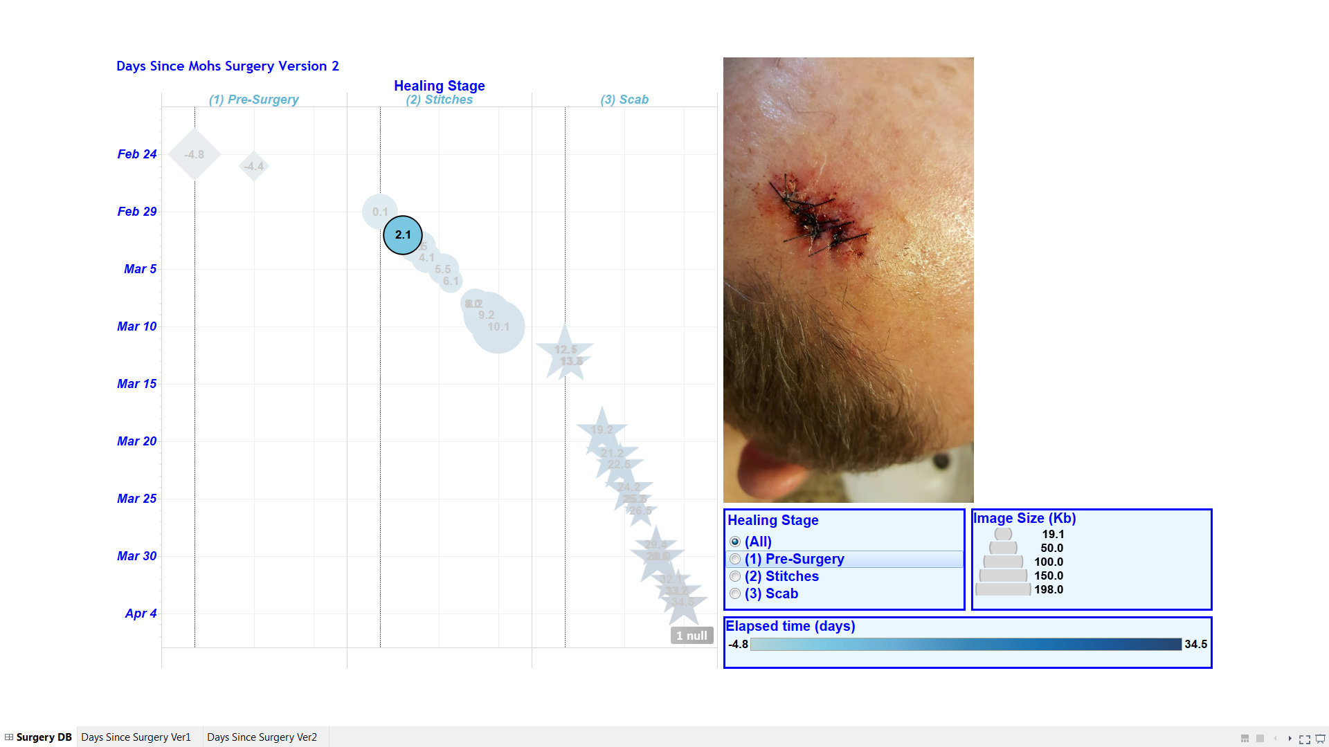 Using Tableau to Visualize Healing After Skin Cancer (BCC) Surgery ...